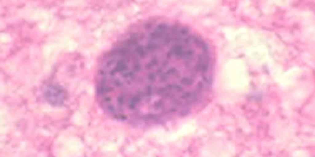 The brain parasite you might not know you have | Fox News Video