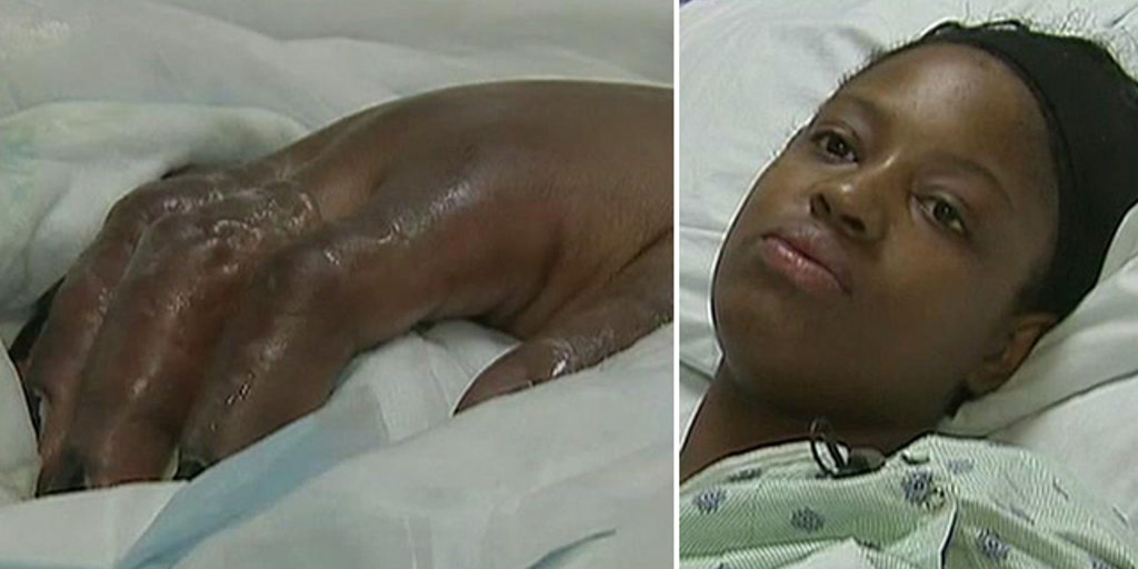 Woman gets frostbite after being outside for just 15 minutes | Fox News ...