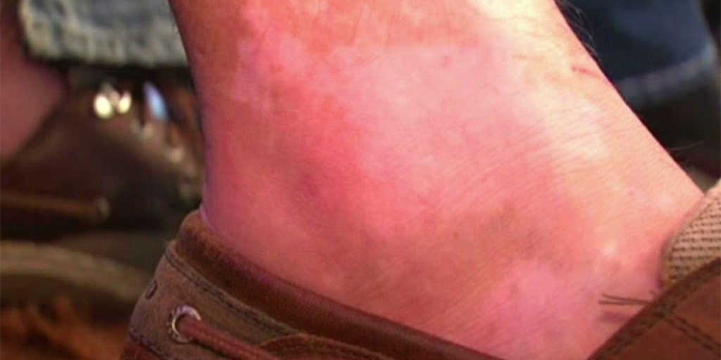 Vitiligo diagnosis and treatment | Fox News Video