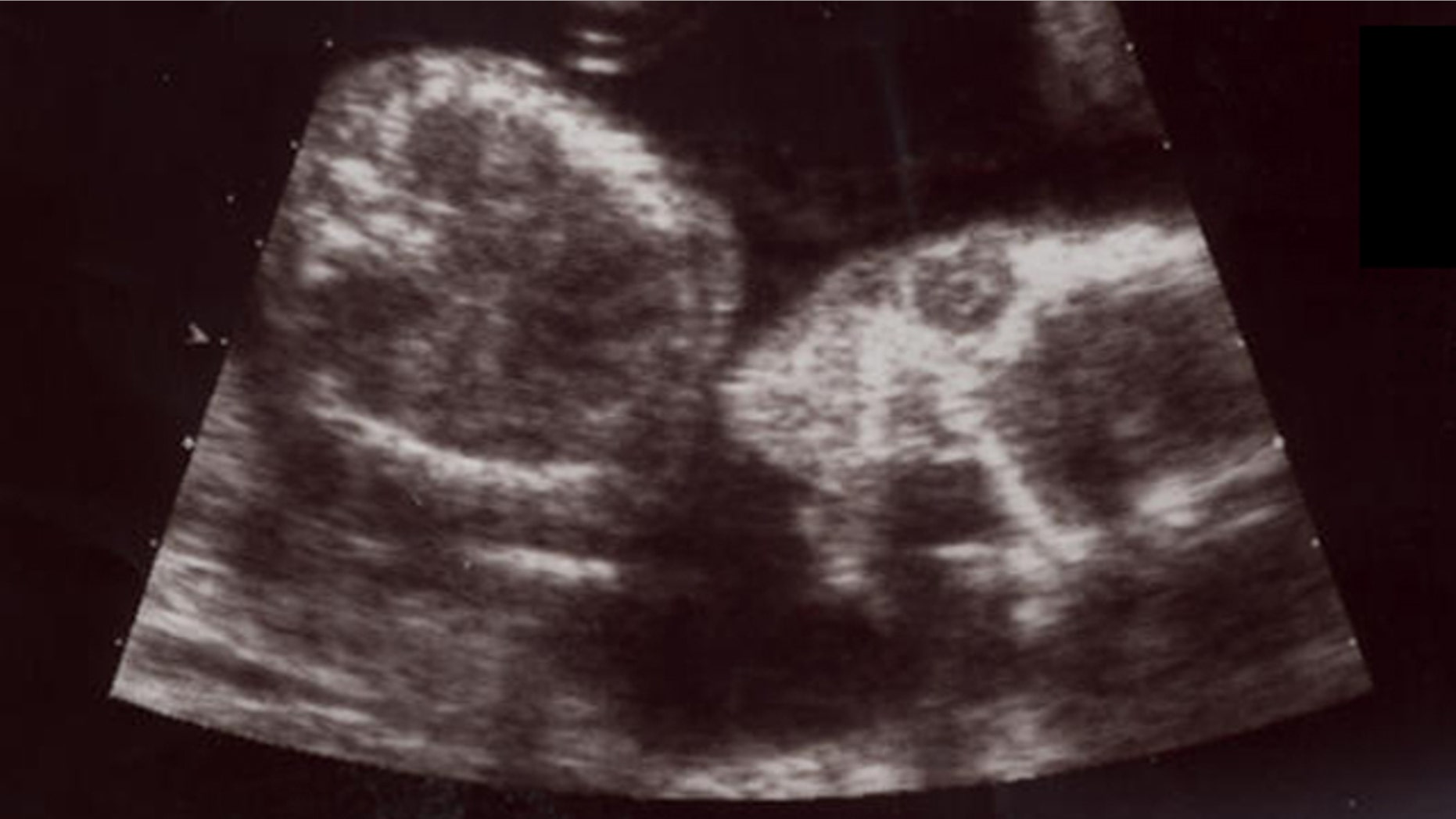Judge strikes down Iowa 'fetal heartbeat' abortion law | Fox News Judge strikes down Iowa 'fetal heartbeat' abortion law | Fox News