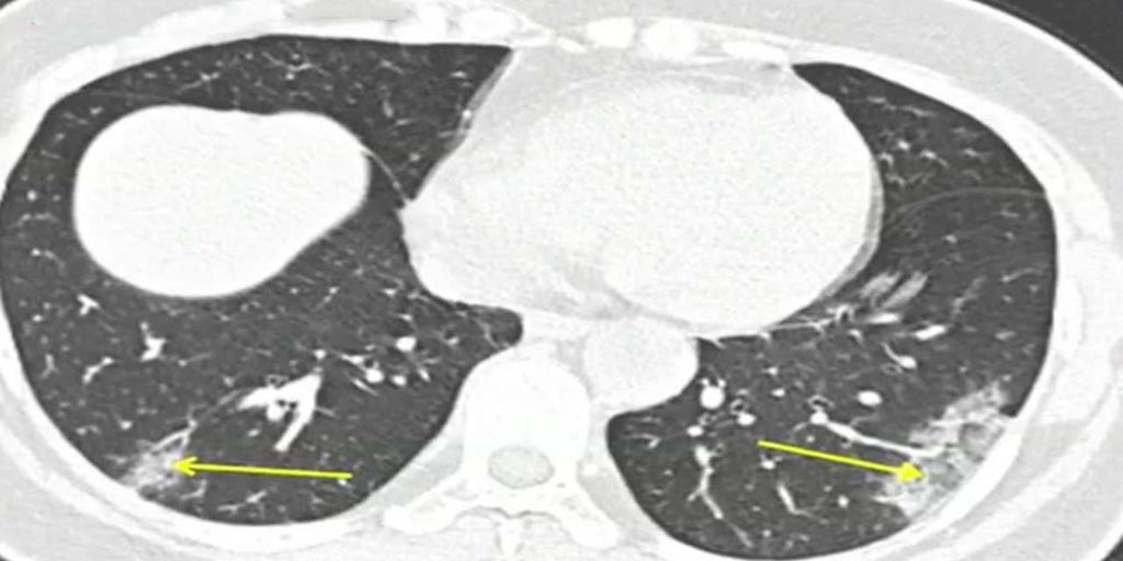 CT scans could accurately diagnose coronavirus | Fox News Video