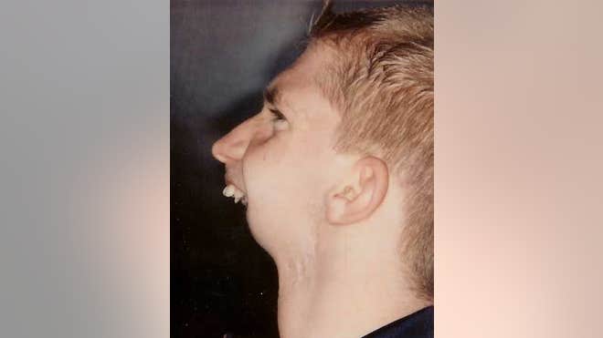 Jawless Boy Begins Long Road to Reconstruction | Fox News