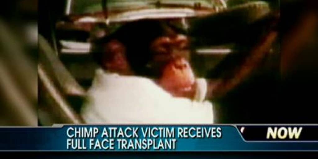 Chimp Attack Victim Receives Face Transplant Fox News Video