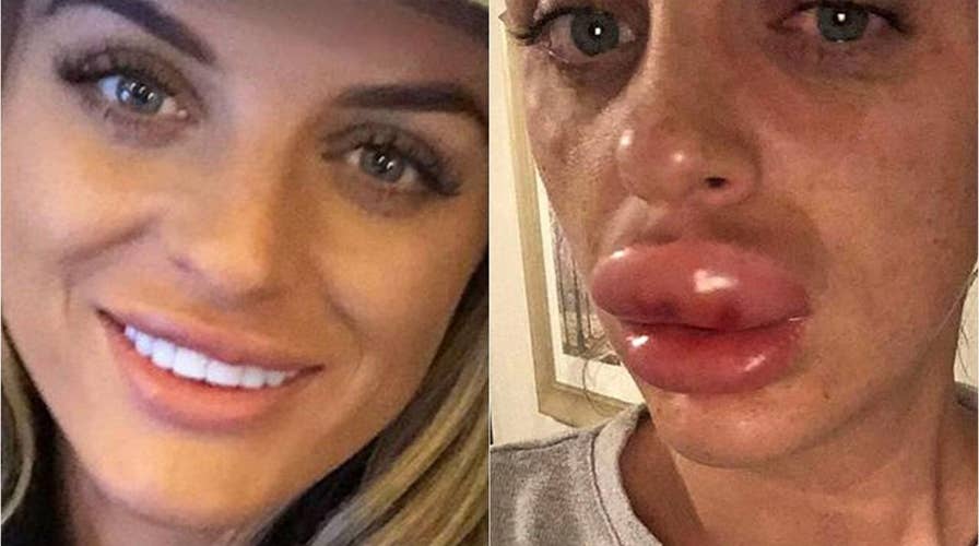 Woman Nearly Lost Top Lip After Getting Botched Fillers At Botox