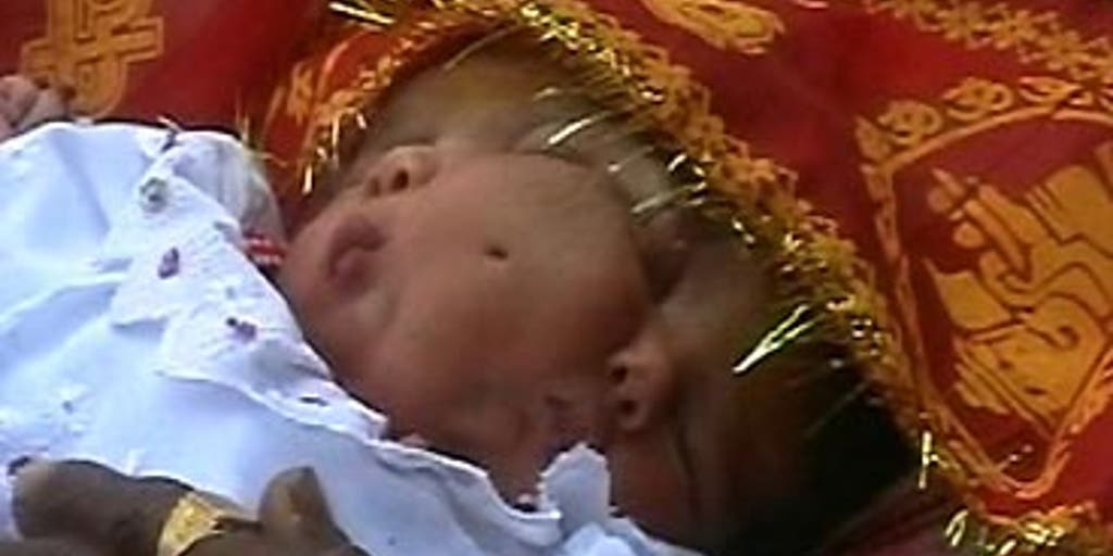 Baby Born With Two Faces | Fox News Video