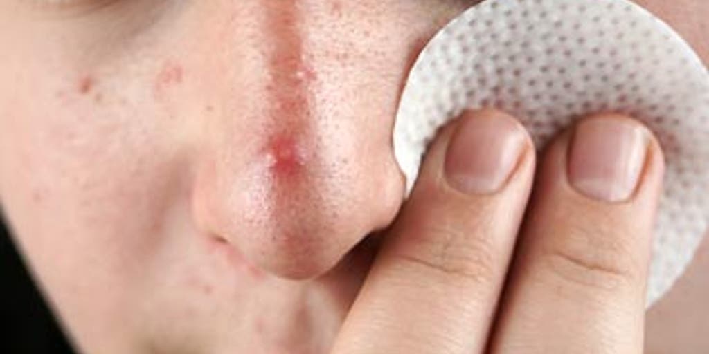 Acne Super Bug | Fox News Video