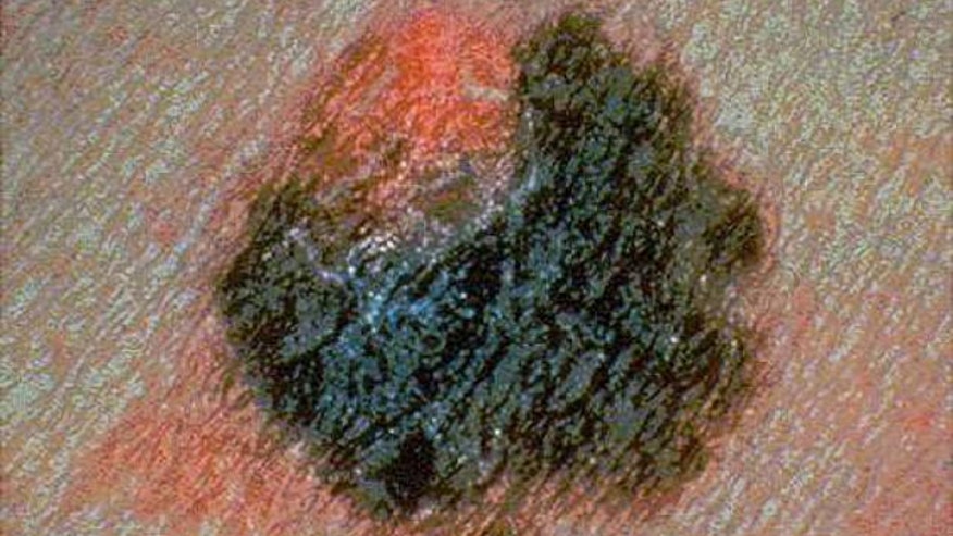 Skin Cancer Awareness Month: How to detect and prevent this deadly ...