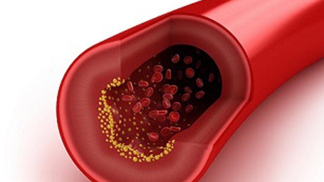 FDA Approves Amgen's Cholesterol-Lowering Drug Repatha | Fox Business
