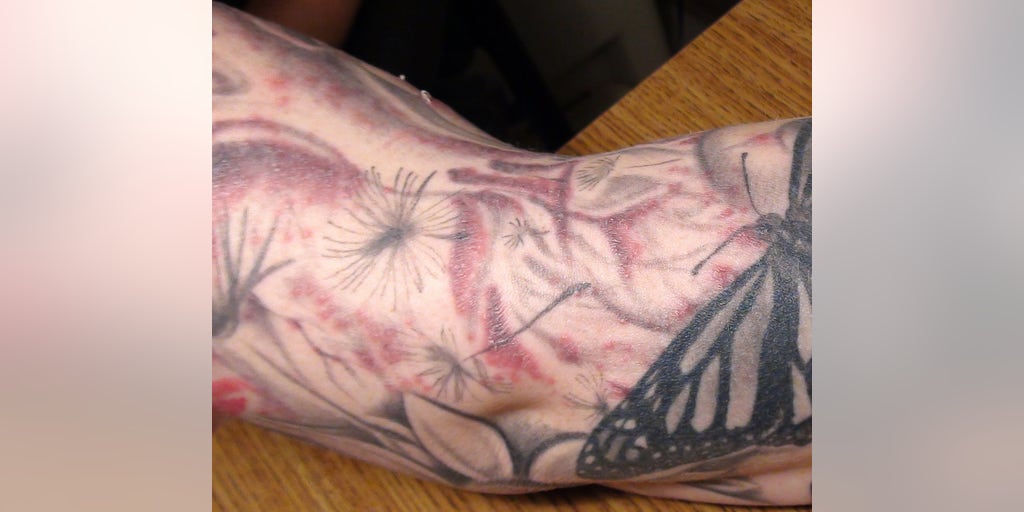 Tattoo rash bumps - Bronctattooaus.com
