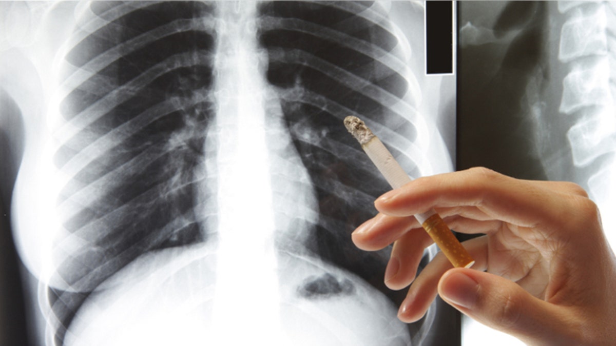 Healthy Lungs Vs Smokers Lungs X Ray