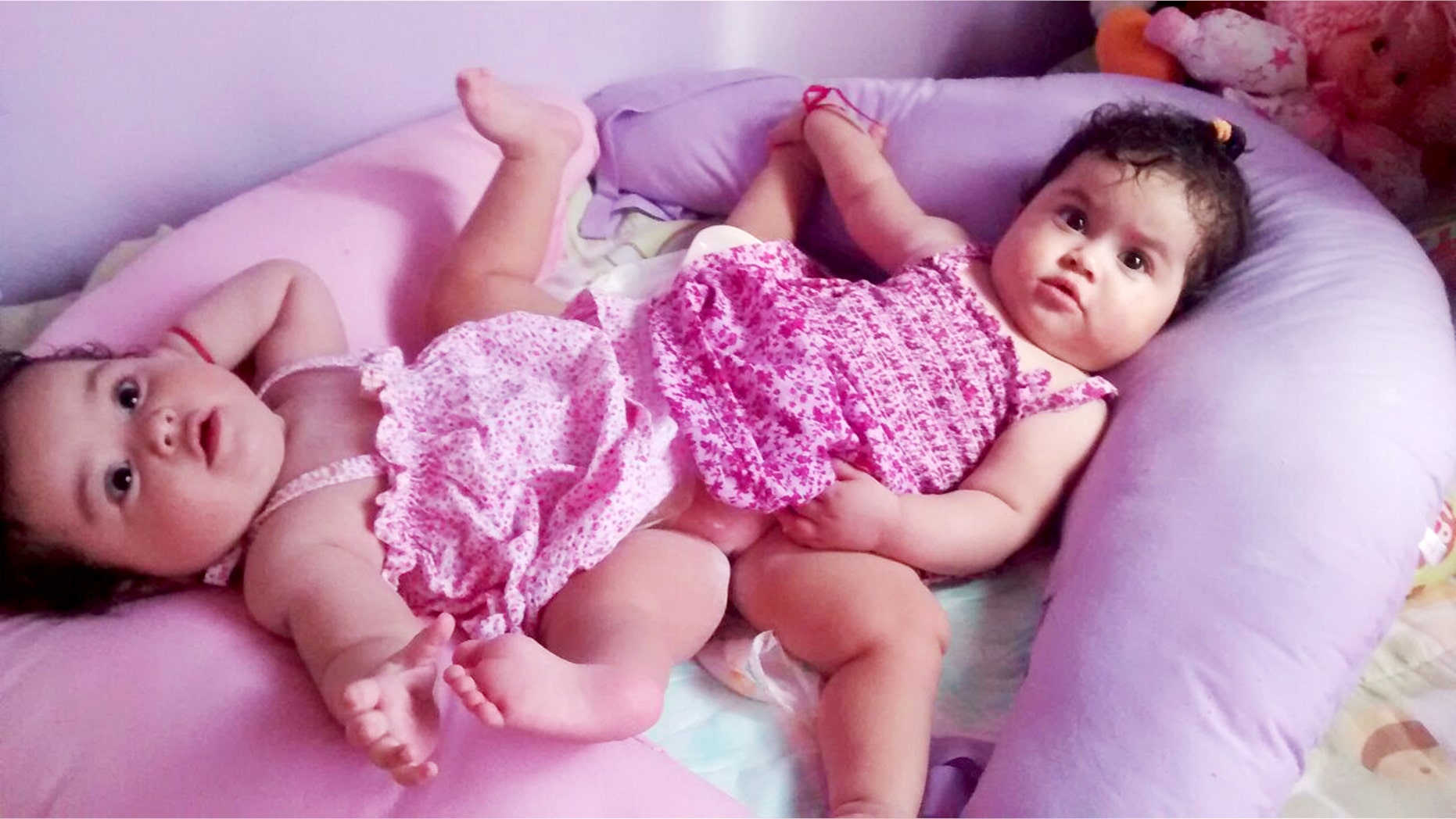 15-month-old twins joined at hip successfully separated | Fox News