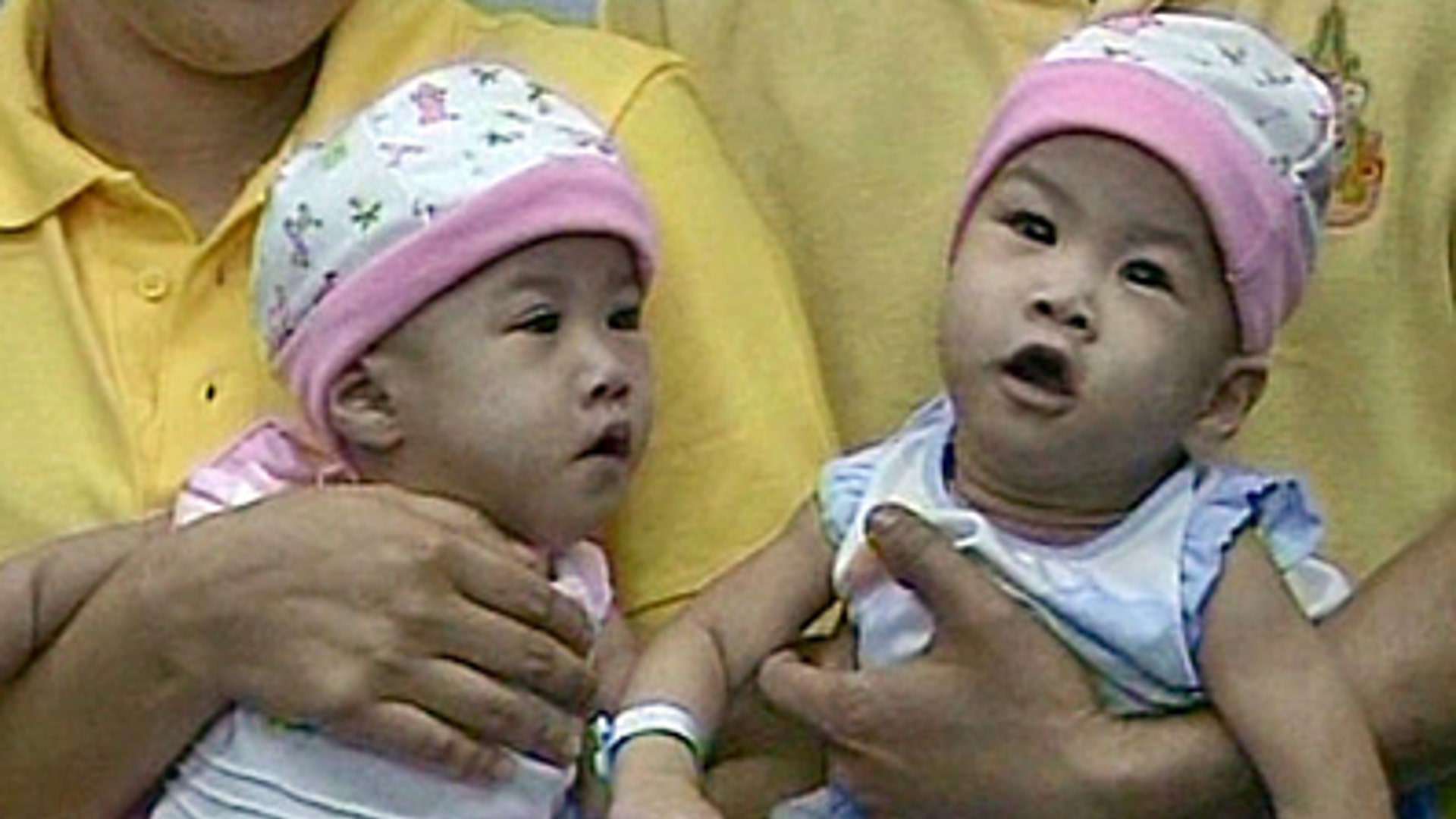 Conjoined Twins | Fox News