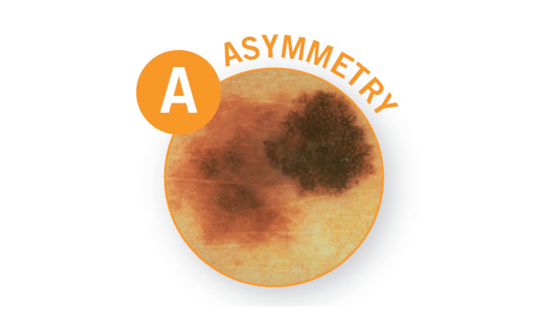 The ABCDEs of skin cancer | Fox News