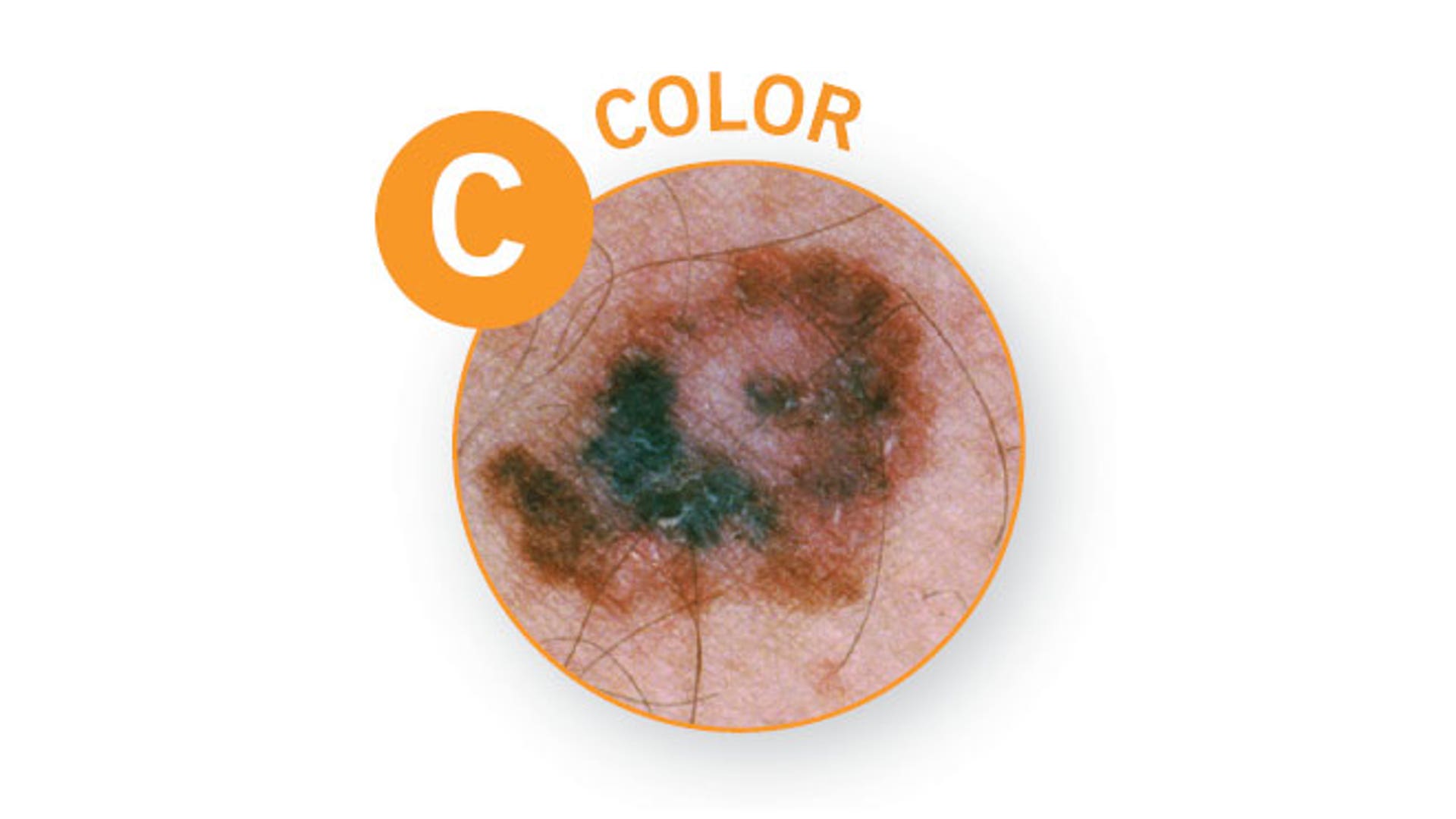 The ABCDEs of skin cancer | Fox News