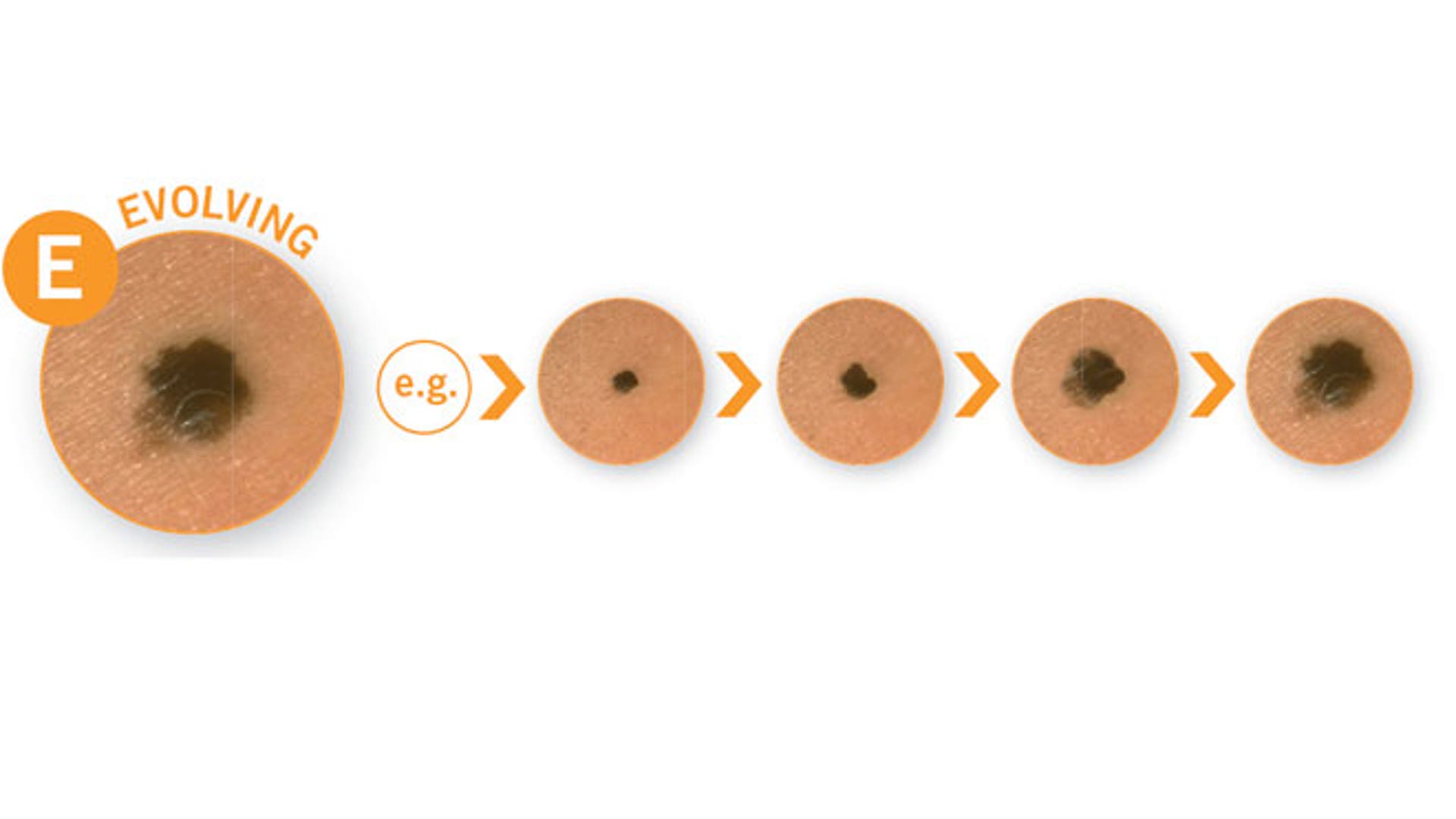 The ABCDEs of skin cancer | Fox News