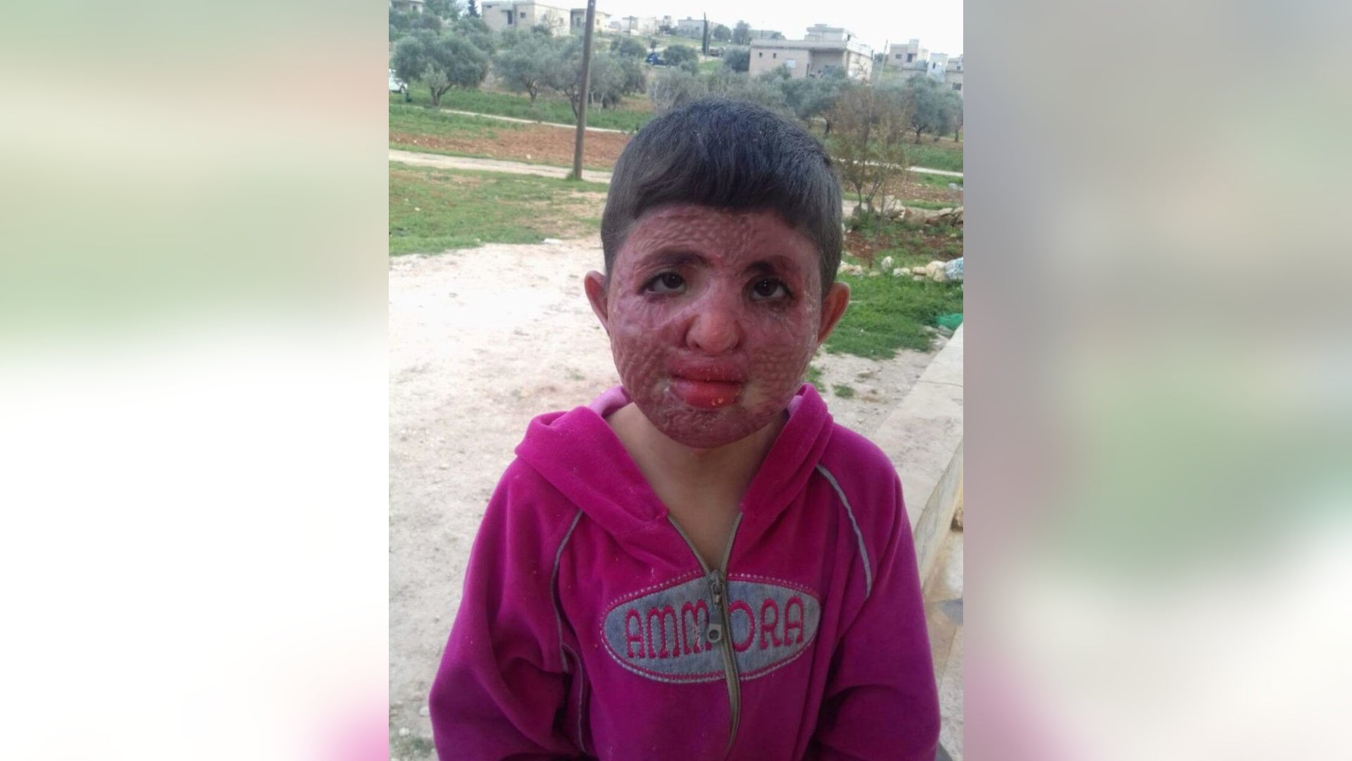 Burned Syrian children find treatment in Texas | Fox News