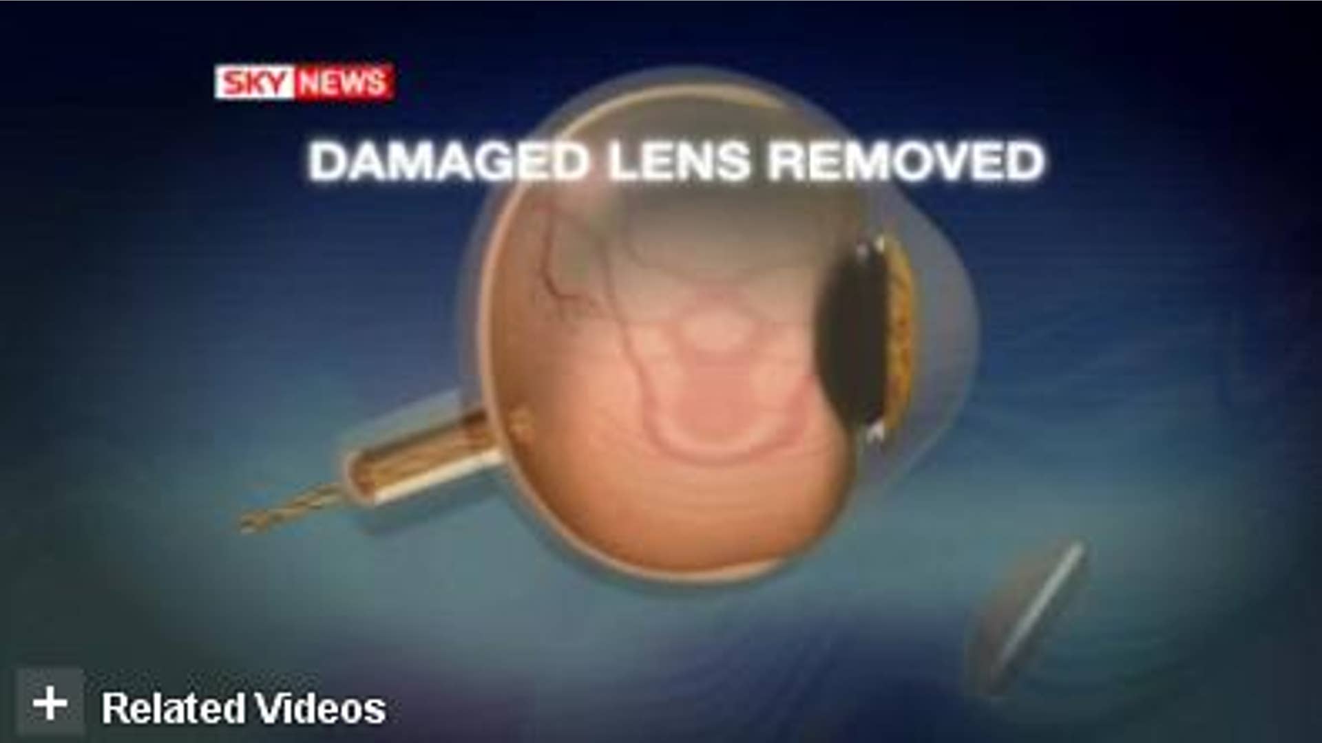 HD Vision? Surgeons Make It a Reality | Fox News