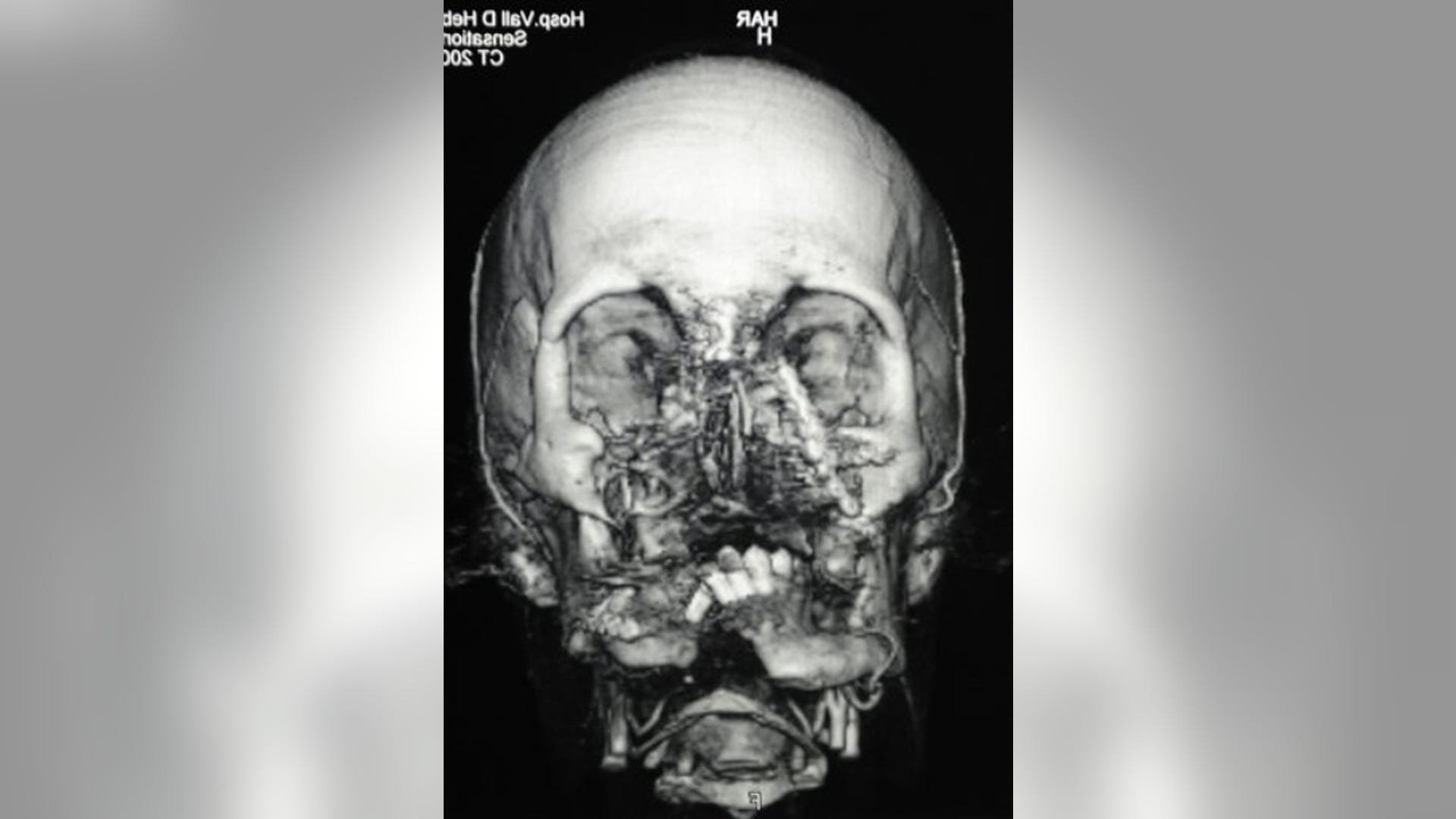 Face Transplant Patient Goes Public | Fox News