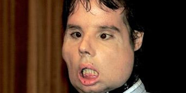 World's First Full Face Transplant Patient Appears in Public | Fox News