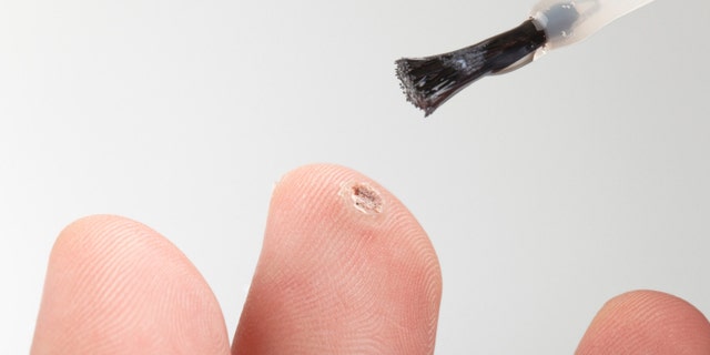 Warts in kids come from family members, classmates | Fox News