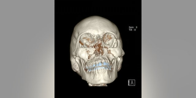 Facebook photos help doctors reconstruct woman's destroyed face after ...