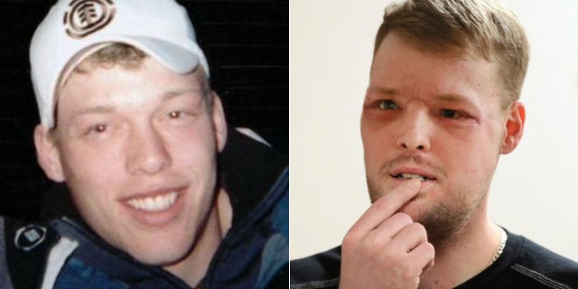 A ‘miracle’ face transplant gives young man a new life | Fox News