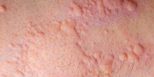 Heat illnesses: 3 harmful effects of extreme heat on the body | Fox News Heat illnesses: 3 harmful effects of extreme heat on the body | Fox News