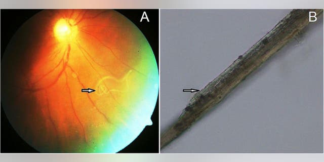 Man's blurred vision caused by worm living in his eye | Fox News