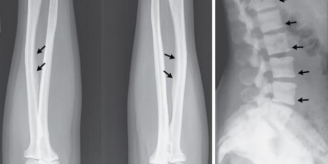 Too much tea causes unusual bone disease | Fox News