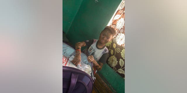 Teen's painful skin condition causes her to 'shed' every 6 weeks | Fox News