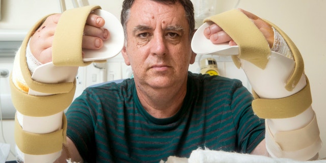 Man doing well after UK's first double hand transplant | Fox News