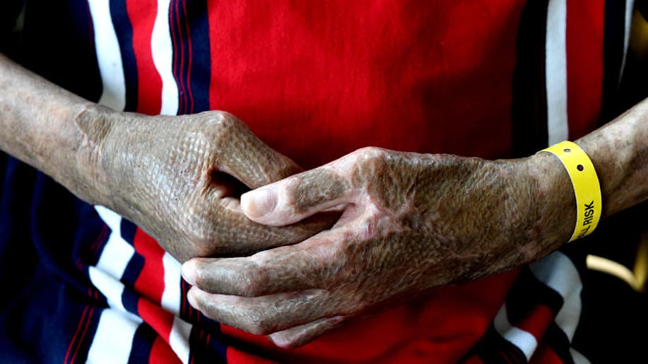 Minnesota burn survivor leaves hospital after 264 days | Fox News