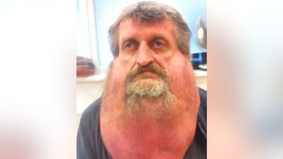 Man To Undergo Second Surgery To Remove 14 pound Tumor From Face Fox News Man To Undergo Second Surgery To Remove 14 pound Tumor From Face Fox News