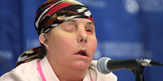 Domestic assault survivor who underwent face transplant loses sight 11 ...