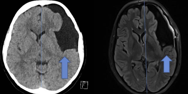 Trip to chiropractor led to brain cyst discovery, woman says | Fox News