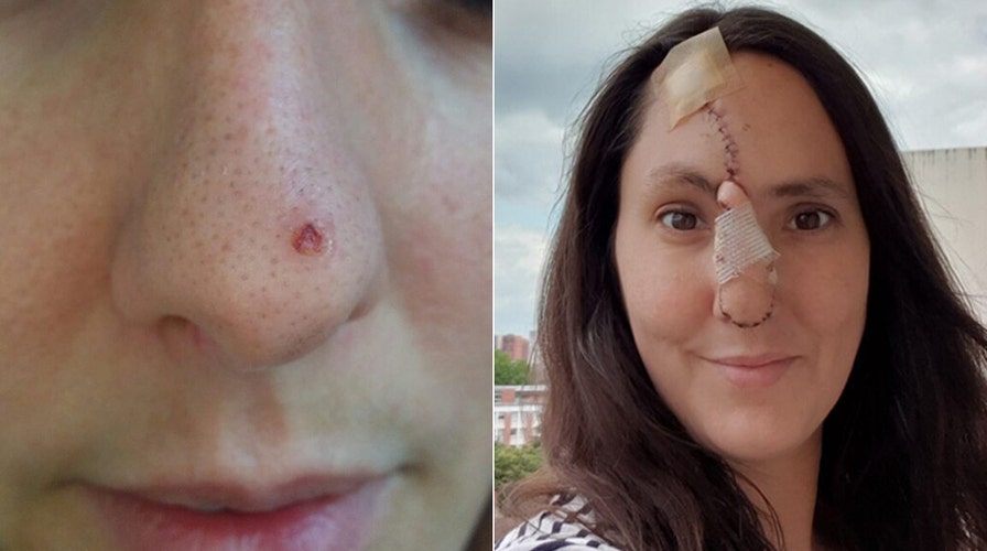 Mom Loses Tip Of Nose After Dismissing Skin Cancer Symptom As Pimple