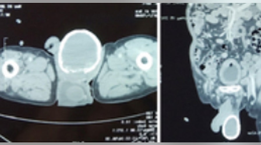 Mans Swollen Calcified Testicle Caused By Parasitic Worm Infection Case Report Fox News