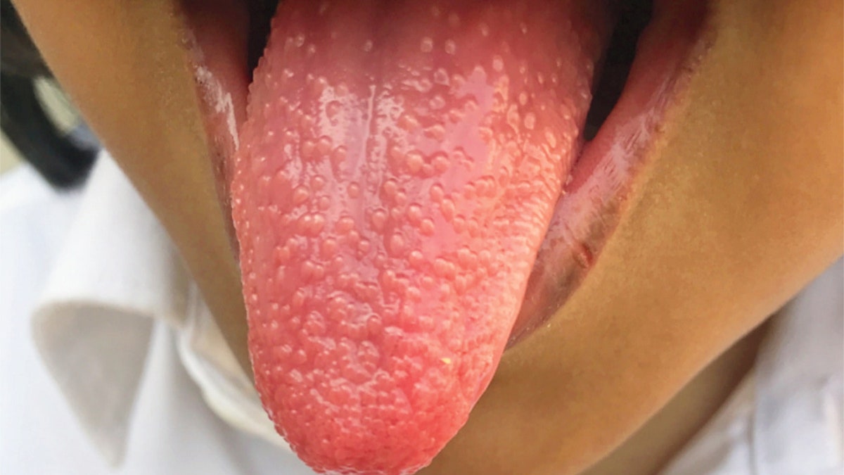 Can Strep Throat Cause Chapped Lips
