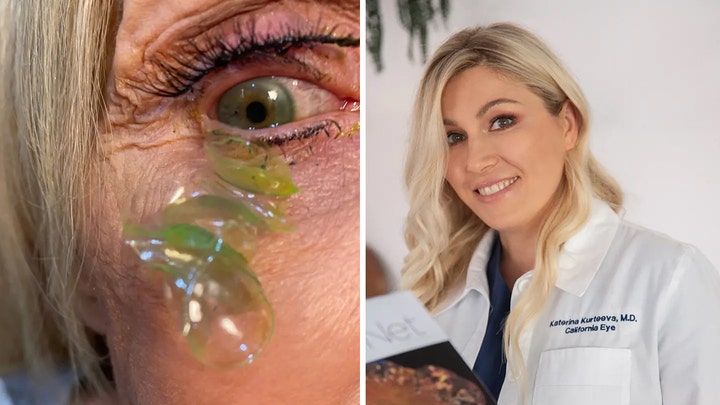 California doctor removes 23 contact lenses from one woman’s eye